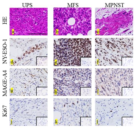 Representative Histopathological Findings In Undifferentiated
