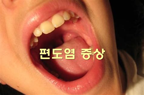 방치해서는 안 되는 급성 편도염 겨울애상