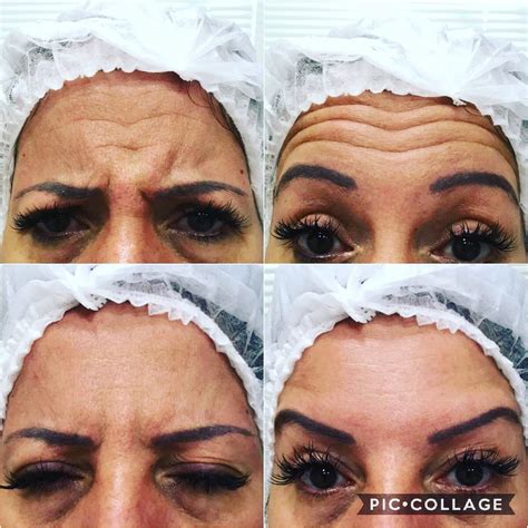 Royal Face Botox ️ Antes E Depois