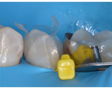 Back To Back Class Ii Composite Bioclear Method Aly Etman