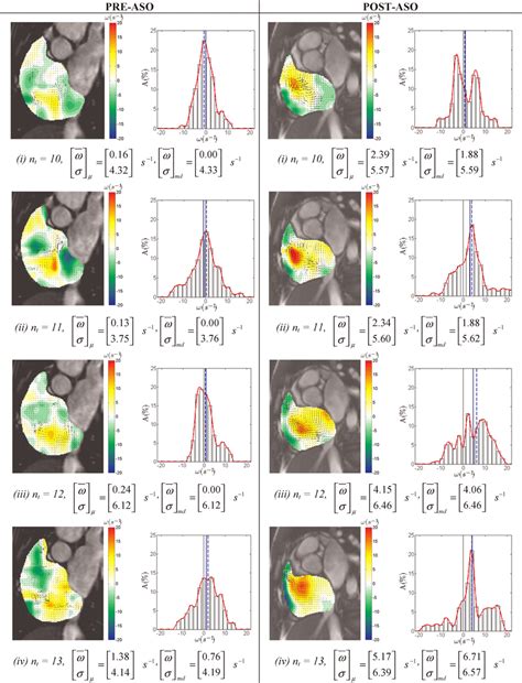 Vorticity Visualization Of Segmented Right Atrium Pre And Post Atrial