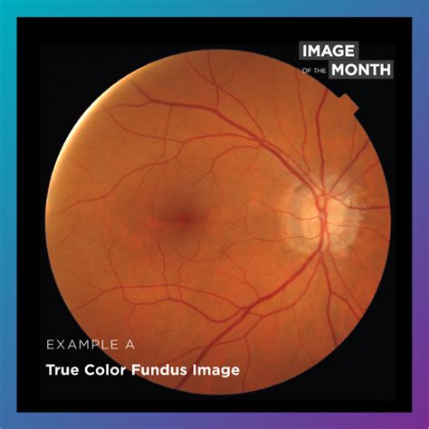 Iotm Optic Nerve Head Drusen Onhd