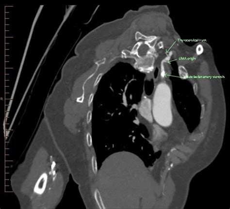 Variant Of Subclavian Steal Syndrome Unusual Anatomical Relationship Between Left Subclavian