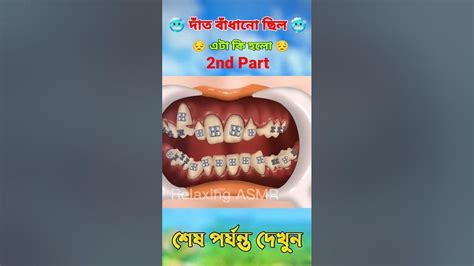 দাঁত বাধানো কিভাবে চিকিৎসা করে Cartoon 3danimation Youtube