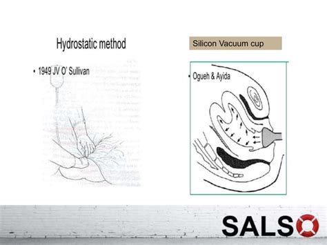 Uterine Inversion 2018 Ppt