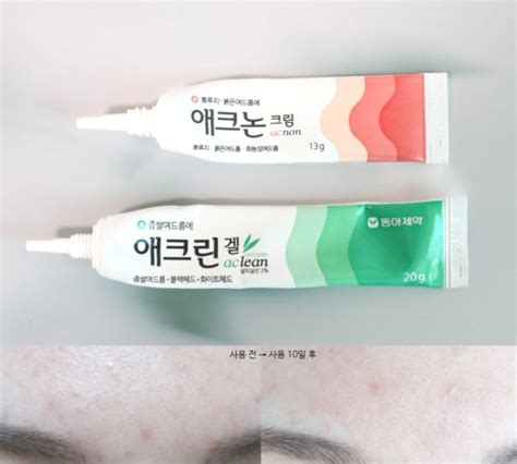 약국좁쌀여드름연고 애크린겔 내돈내산 후기 애크논 비교 네이버 블로그