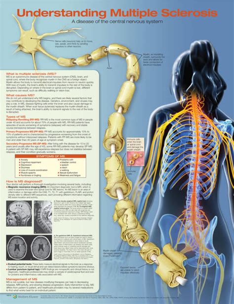 Understanding Multiple Sclerosis Chart Adamrouilly