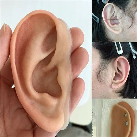 Silicone Ear Prosthesis At ₹ 30000 Silicone Ear Prosthesis In Kolkata Id 2852227420248