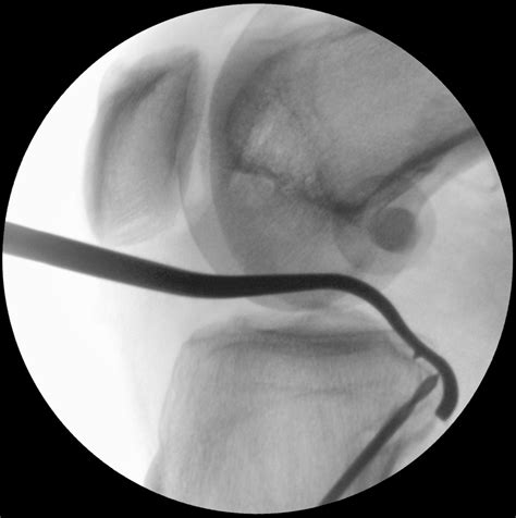Pcl Reconstruction Posterior Cruciate Ligament
