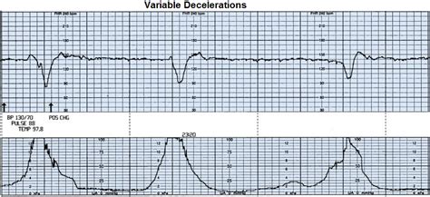 Variable Decelerations Explained