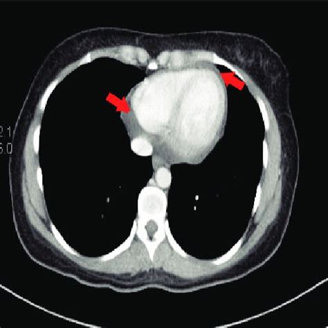 Representative Transaxial Thin Computed Tomography Sections At Low