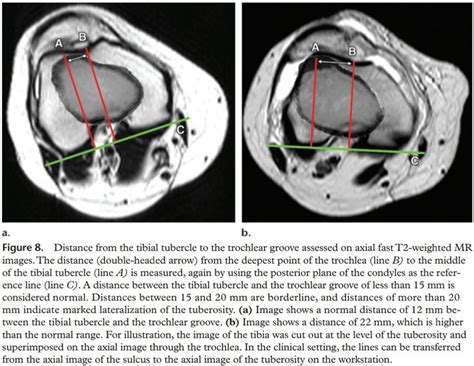 Tibial Tubercle Trochlear Groove Distance Normal Less Than 15mm