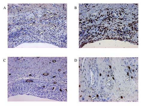 Expression Of Hif 1α Cd68 And Cd31 In Ra Synovial Tissue