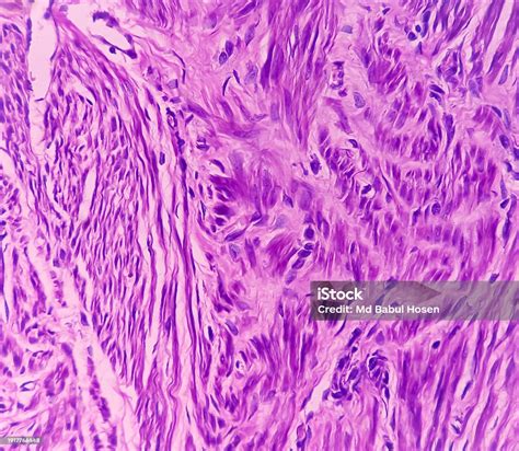 Uterus With Adnexa Cervix Show Chronic Inflamatory Cells Wall Show