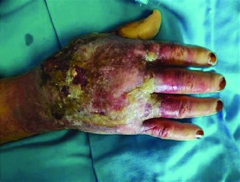 Cellulitis Of The Hand At Admission Exuberant Edema Of Hand And Distal