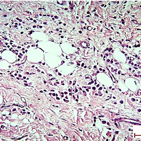 Diffuse Infiltration Of Lobular Carcinoma In The Breast As Single