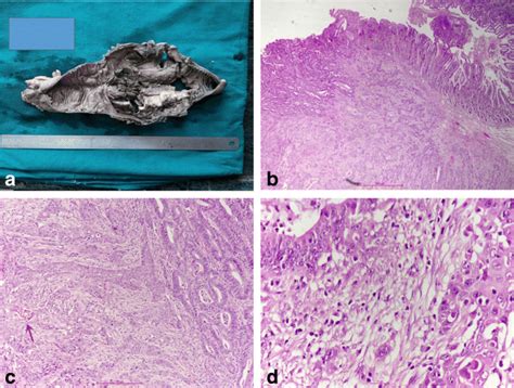 A Gross An Ulcer Infiltrative Circumferential Mass Measuring