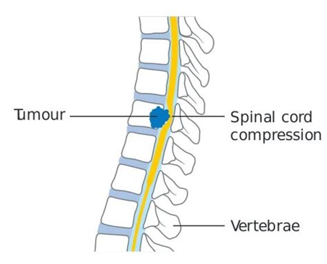 Spinal Cord Compression Nurses Revision