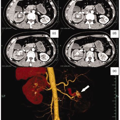 Computed Tomography Angiography A Cross Sectional Ct Shows