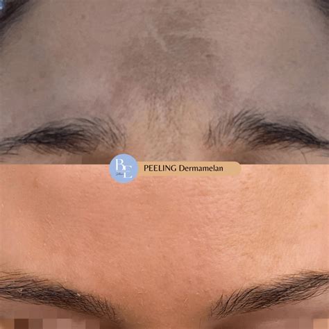 Peeling Medico Bellessere