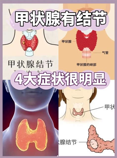 深圳治疗甲状腺结节最好的医院在哪里？甲状腺结节应该忌口吗？【暨南大学崇爱医院】 哔哩哔哩
