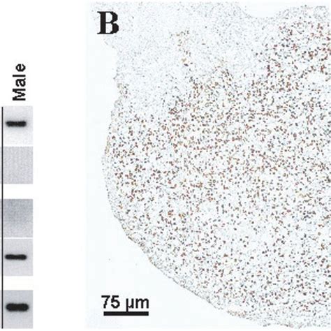 Expression Profiles Of Sex Differentiating Genes In The Gonads Of Goat