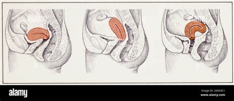 Positions Of The Uterus Normal Retroflexion And Retroversion