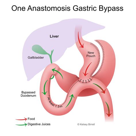 One Anastomosis Gastric Bypass Mini Toowoomba Bariatric Surgery
