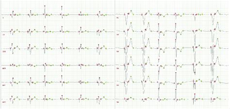 Id 8 Age 57 Sex F Atrial Fibrillation Electric Axis Of The