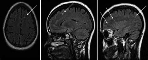 Migraine Brain Mri