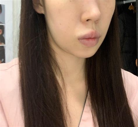 파워v얼굴지방흡입 V핏리프팅 후기 닥터정 리반의원