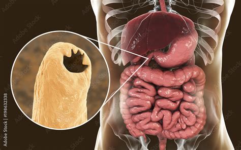Parasitic Hookworm Ancylosoma Duodenale In Human Duodenum Stock