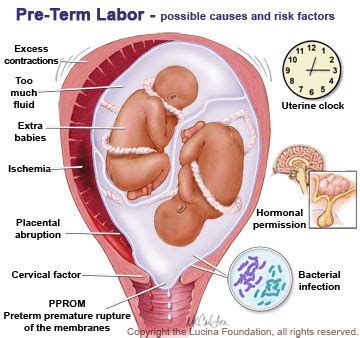 Preterm Labor Nursing Care Plan Management RNpedia