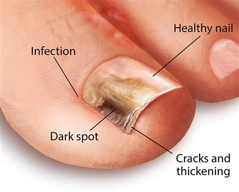 Toenail Fungus Momentum Foot And Ankle Wellness Center