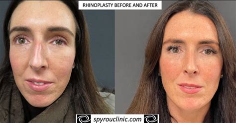 George Spyrou On Linkedin Rhinoplasty Liplengthening