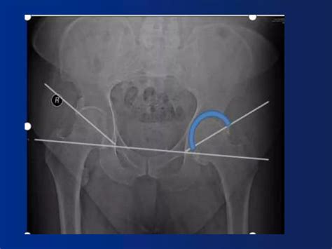 Pre Operative Templating In Total Hip Arthroplasty Pptx Bone And Joint Conditions Diseases