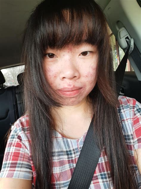 What Did You Do Literally Everything Probably Lol Rtretinoin
