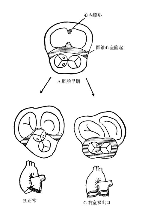 图34 1 右室双出口的发生 心脏外科基础图解 医学