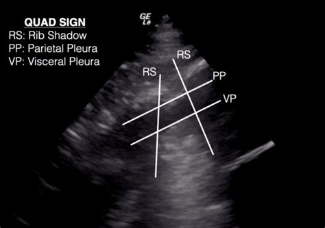 Lung Ultrasound Made Easy Step By Step Guide Pocus 101