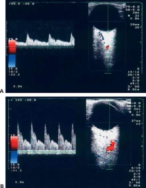 A The Peak Systolic Velocity Psv 32 Cmsn Enddiastolic Velocity