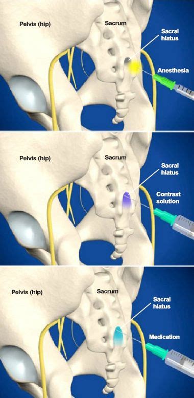 What Is The Best Injection For Sciatica