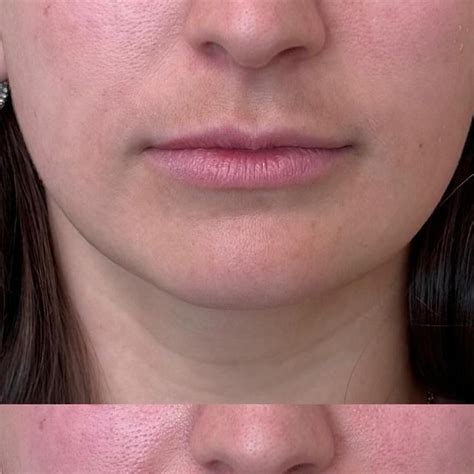 Injector Brett Aprn Np C On Instagram Facial Balancing Natural