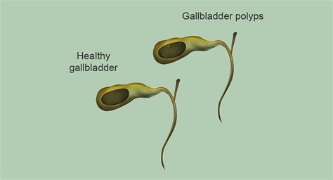 Polyps In Gallbladder Cheap Buying Gt