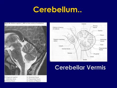 Vermis Mri