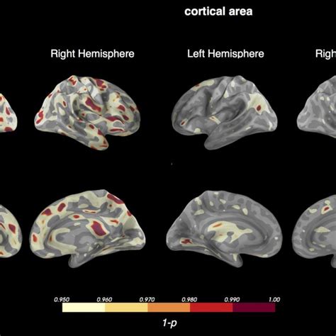Vertex Wise Analysis Of Cortical Volume And Thickness Comparing The