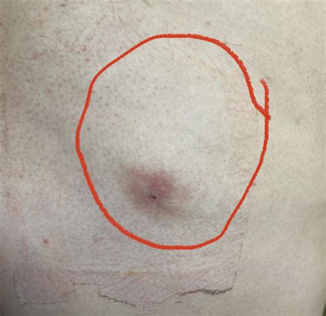 Confirmed Staph Infection After It Came Back After My First Round Of Antibiotics Rmrsa