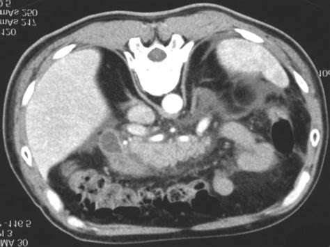 Multidetector Computed Tomography Scan Peripancreatic Fat Necrosis