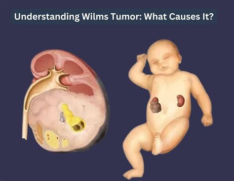 Understanding Wilms Tumor What Causes It Dr Vishesh Dikshit