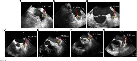 Figure 2 From Percutaneous Left Atrial Appendage Closure Using The Lambre Device In Patients