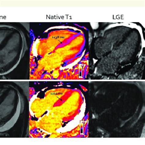 Cardiac Systemic Light Chain Amyloid Progression On Serial
